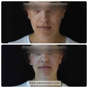 Midface volume restoration with fillers in Sofia - Dr. Stavrov Aesthetics